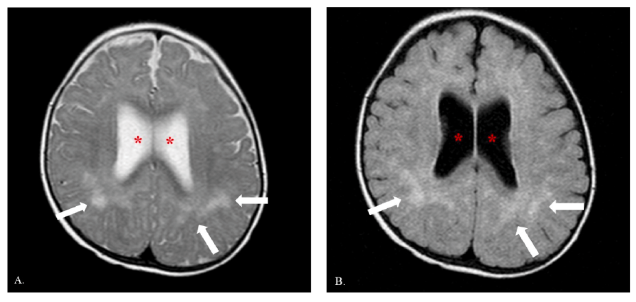 Preconceptional immunity and congenital Cytomegalovirus infection - a ...