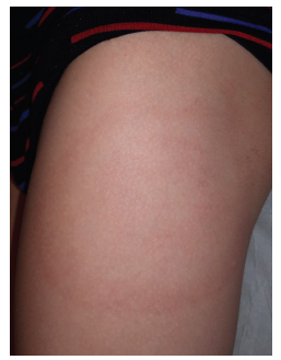 Dermatology clinical case