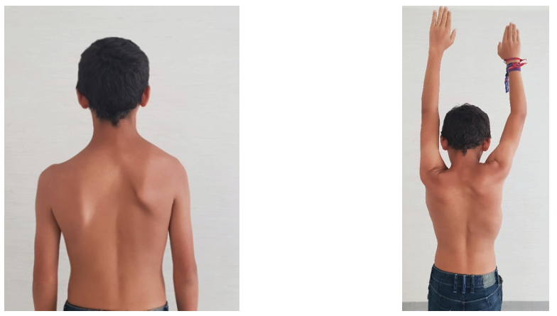 Misaligned shoulders