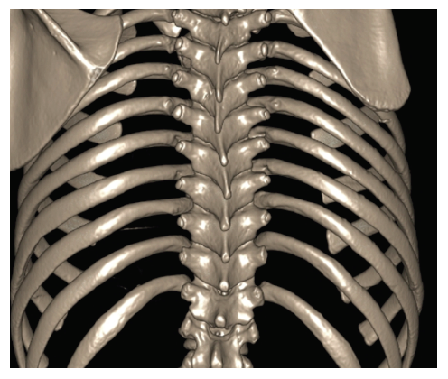 Misaligned shoulders