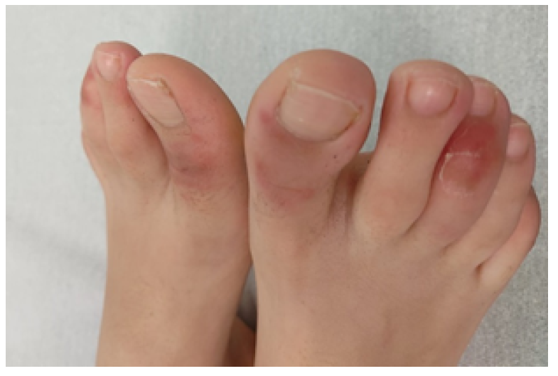 Chilblain-like lesions in a pediatric patient