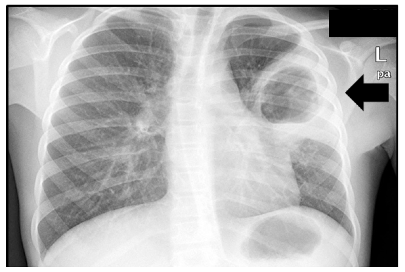 An ill-appearing child with skin lesions and respiratory distress