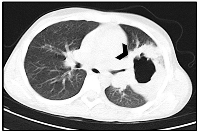 An ill-appearing child with skin lesions and respiratory distress