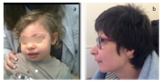 Nijmegen breakage syndrome: The importance of follow-up