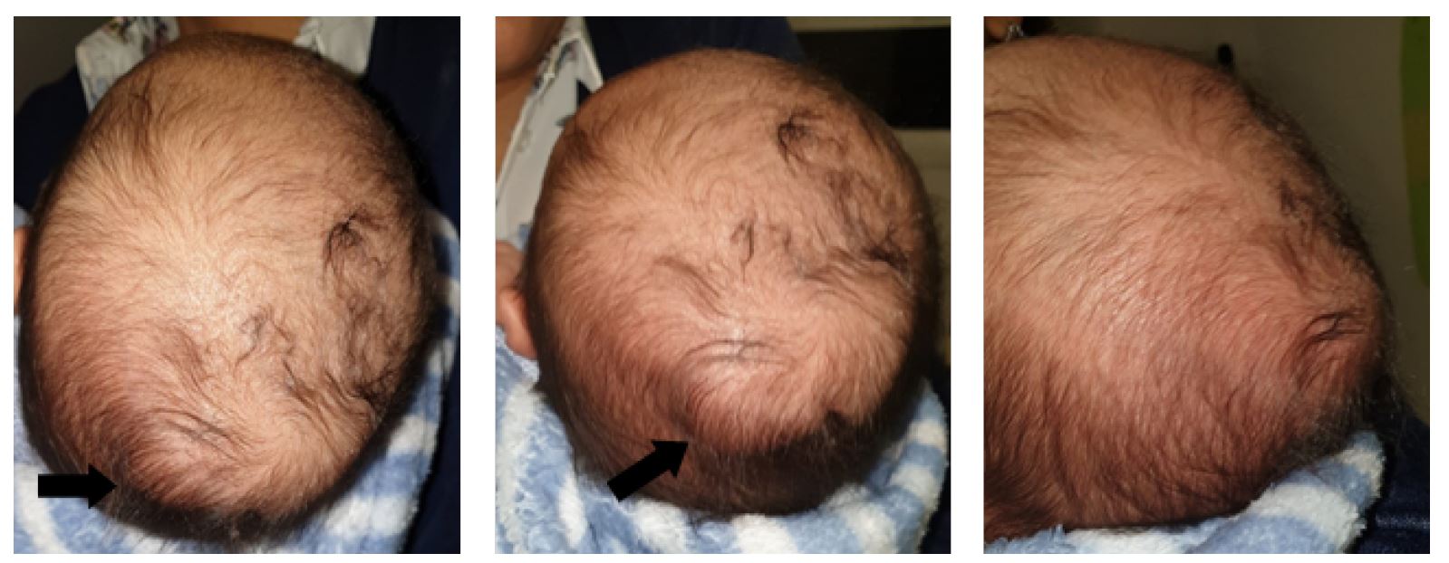 Delayed subaponeurotic fluid collection: An unusual cause of scalp swelling