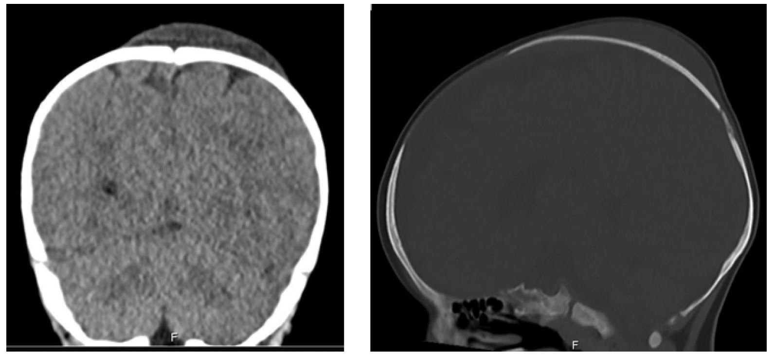 Delayed subaponeurotic fluid collection: An unusual cause of scalp swelling