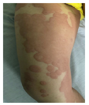 Pruritic rash in a child - Clinical case