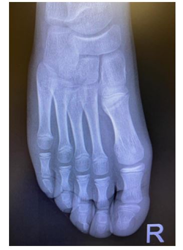 Lump in a child’s toe