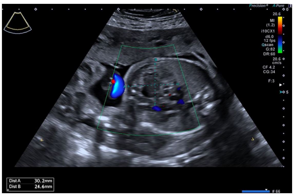 Successful management of a fetal mediastinal teratoma − Case report