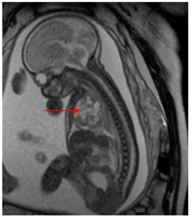 Successful management of a fetal mediastinal teratoma − Case report