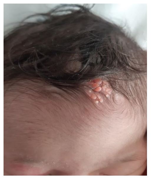 Congenital birthmarks: A common finding in newborns