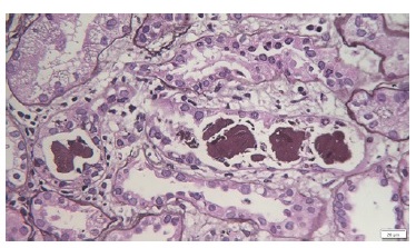 Yellish kidney: a case of cast nephropathy