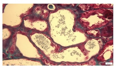 Yellish kidney: a case of cast nephropathy
