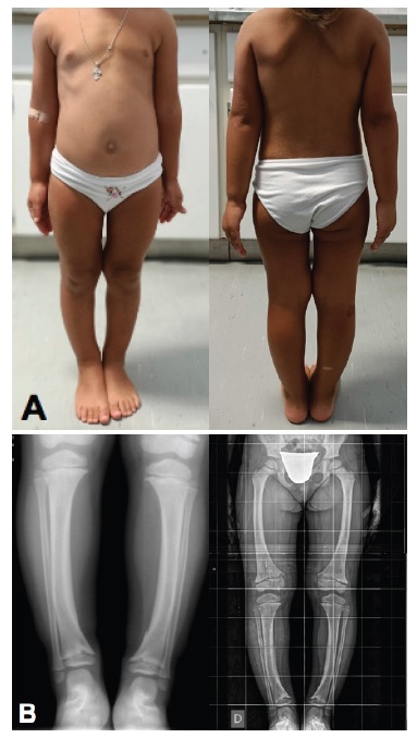 X-Linked Hypophosphatemic Rickets: A Pediatric Case Report