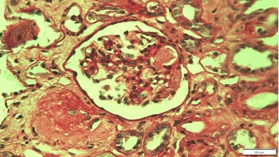 Early Acute Allograft Dysfunction in a Patient with Antiphospholipid ...