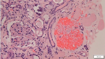 Early Acute Allograft Dysfunction in a Patient with Antiphospholipid ...