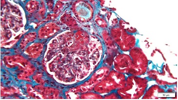 Early Acute Allograft Dysfunction in a Patient with Antiphospholipid ...
