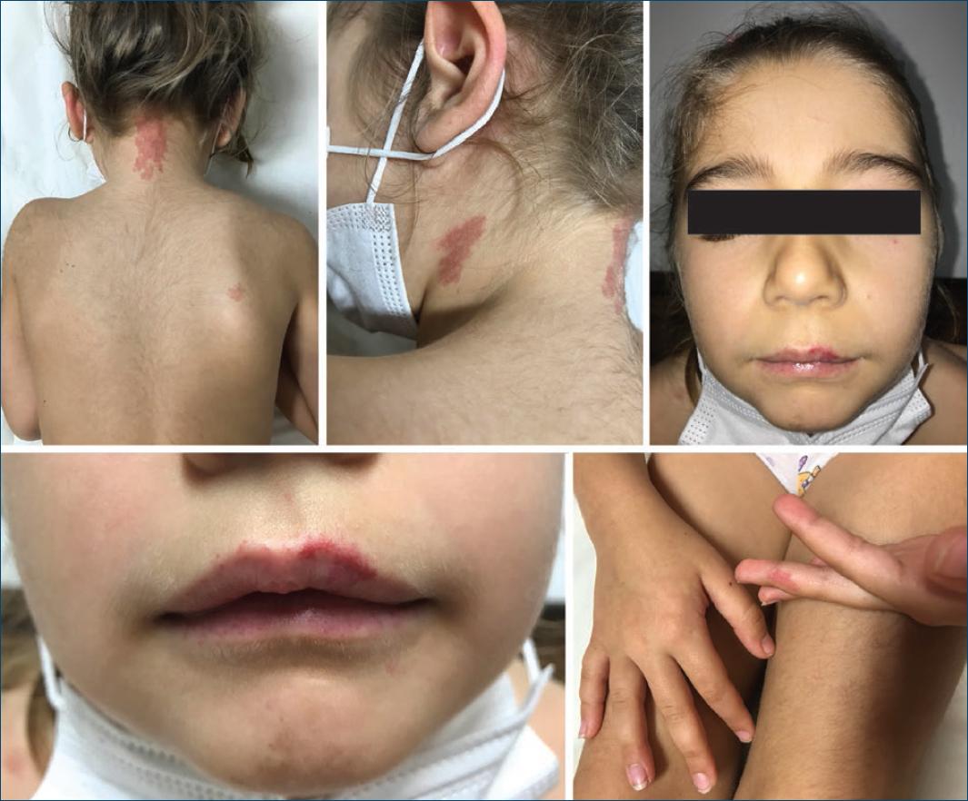 Do not ignore multiple capillary malformations in a child