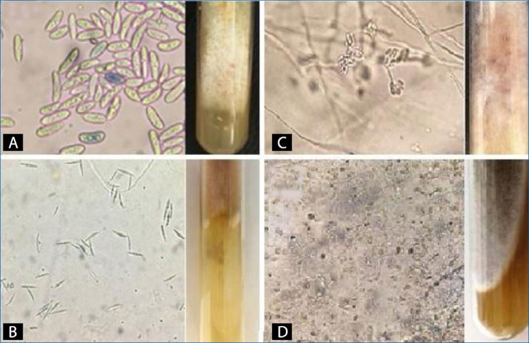 Laboratory diagnosis and prevalence of onychomycosis caused by Fusarium ...