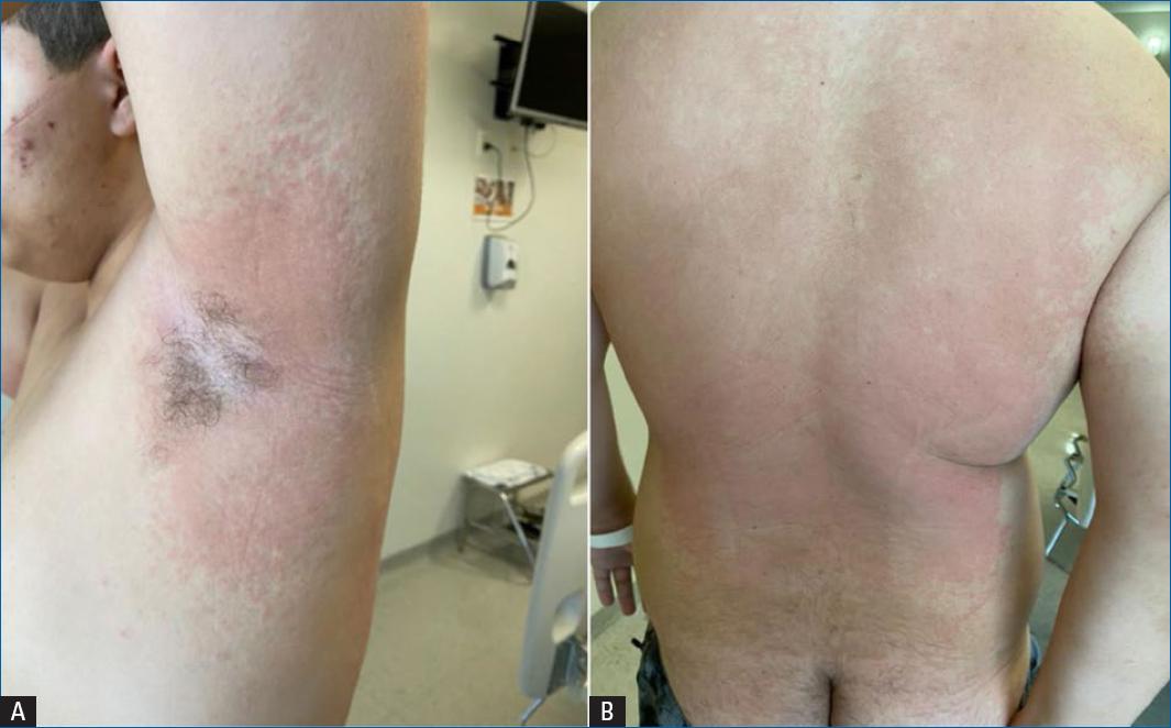 Cutaneous ectopic schistosomiasis associated with Löffler syndrome. A ...