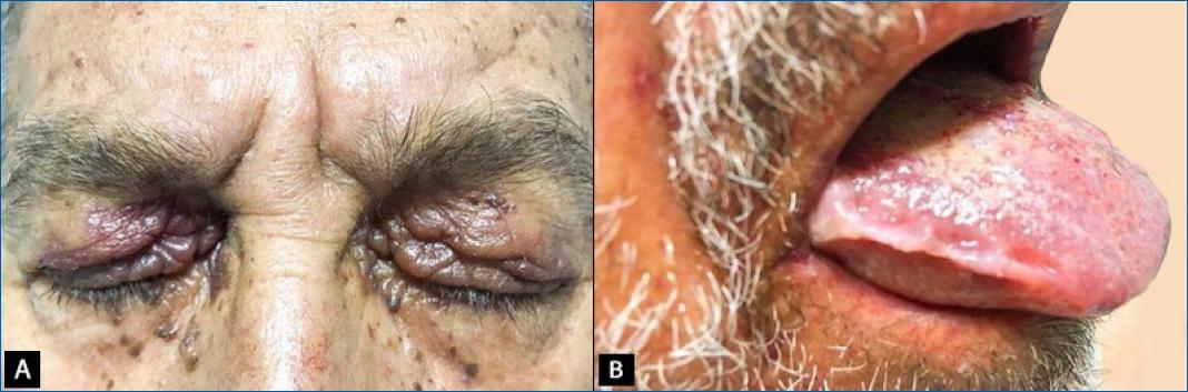 Elderly man with macroglossia and periorbital ecchymosis
