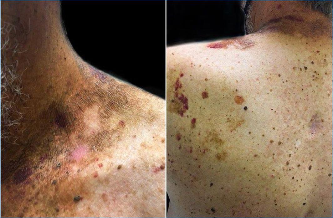 Elderly man with macroglossia and periorbital ecchymosis