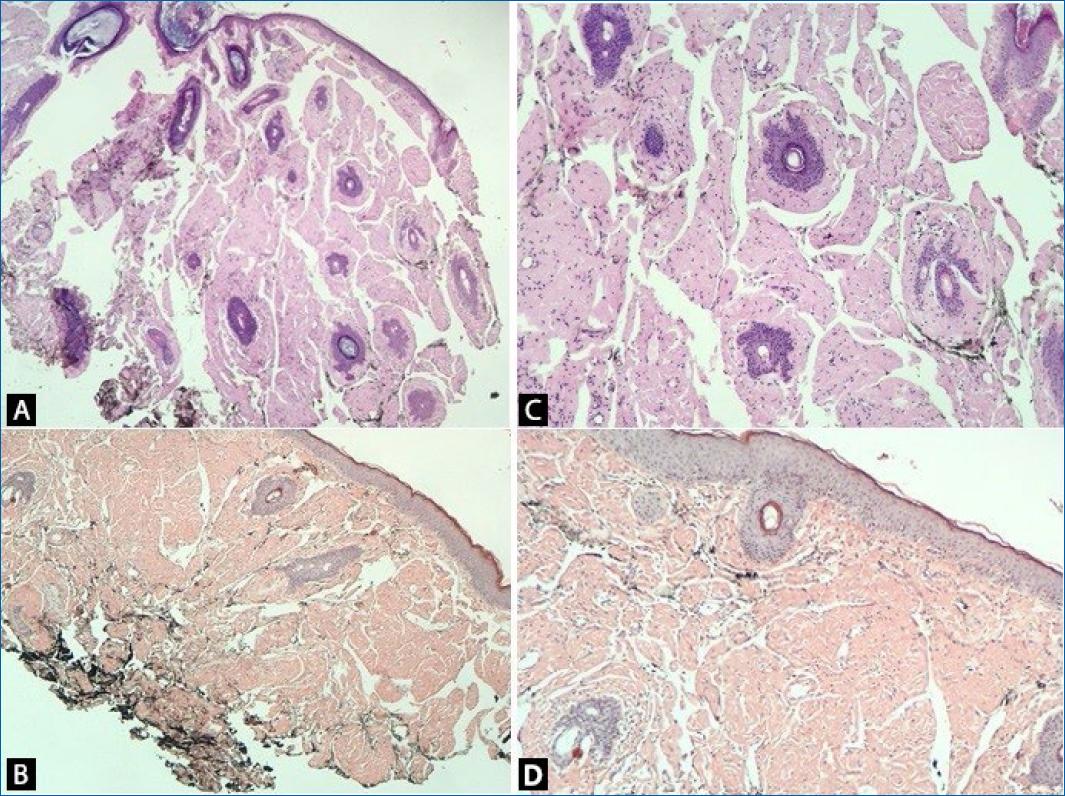Elderly man with macroglossia and periorbital ecchymosis