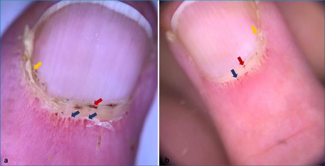Nail fold capillary abnormalities in dermatomyositis using a handheld ...