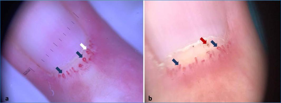 Nail fold capillary abnormalities in dermatomyositis using a handheld ...