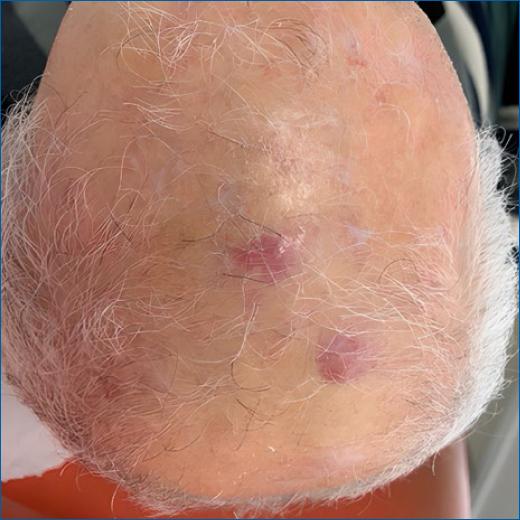 Scalp angiosarcoma in elderly patient: case report