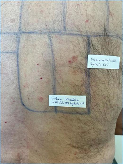 Titanium hypersensitivity in a patient with a titanium medical implant