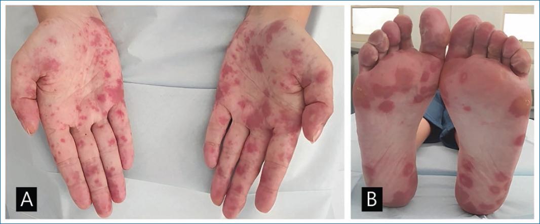 Hand, foot, and mouth disease and palmoplantar erythrodysesthesia in a ...