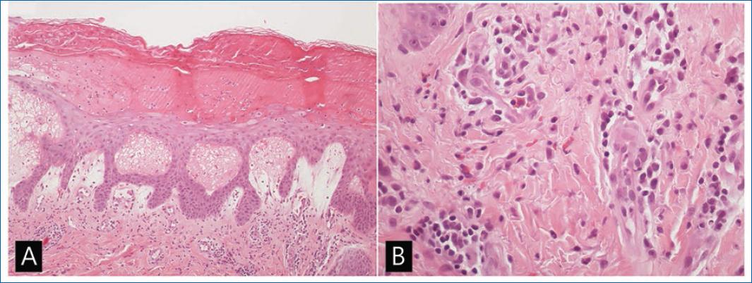 Hand, foot, and mouth disease and palmoplantar erythrodysesthesia in a ...