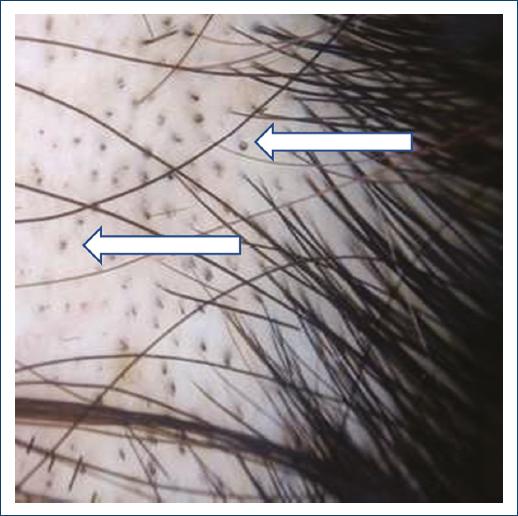 Trichoscopy in alopecia areata and trichotillomania