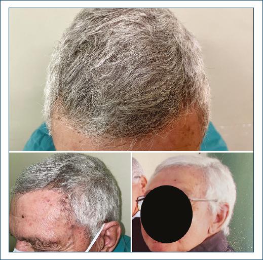 Cyclosporine-induced hair repigmentation
