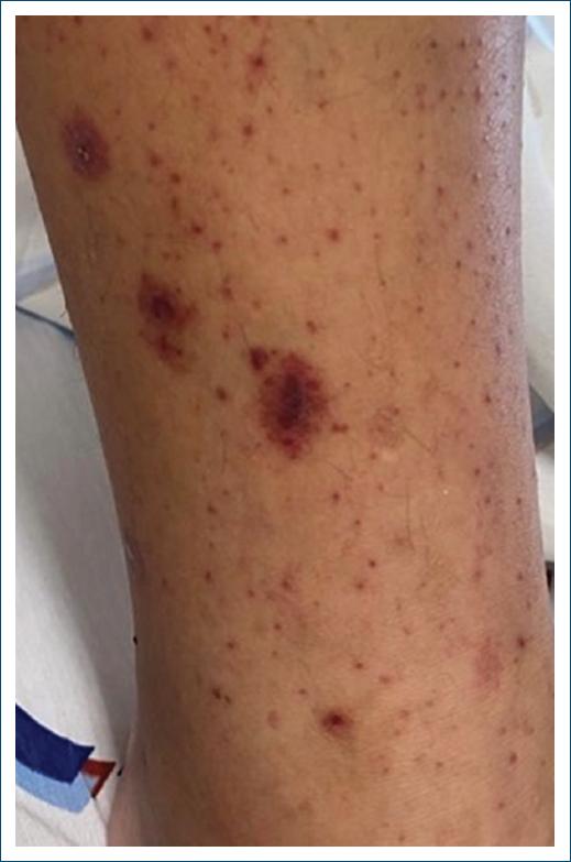 Scurvy, a forgotten disease but still a reality: case report