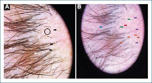 Trichoscopic findings in folliculotropic mycosis fungoides: case report