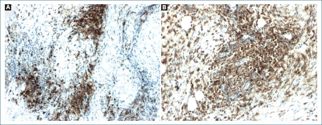 A rare case of granulomatous slack skin with scarce multinucleated ...