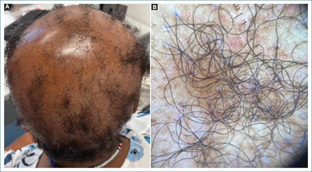 Central centrifugal cicatricial alopecia: a subtype of lichen ...