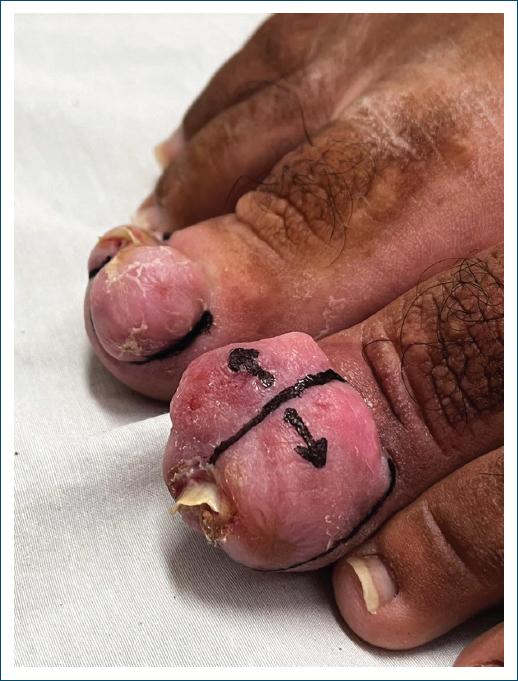 Surgical treatment of aberrant nail fold hypertrophy secondary to ...