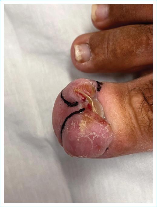 Surgical treatment of aberrant nail fold hypertrophy secondary to ...