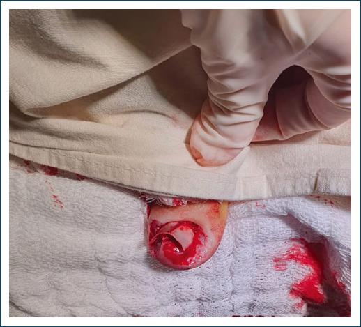 Surgical treatment of aberrant nail fold hypertrophy secondary to ...