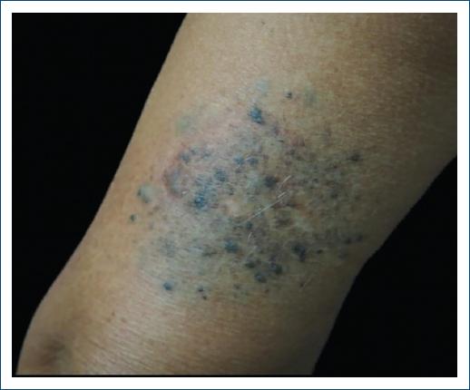 Extending agminated blue nevus in an immunosuppressed patient: a case ...