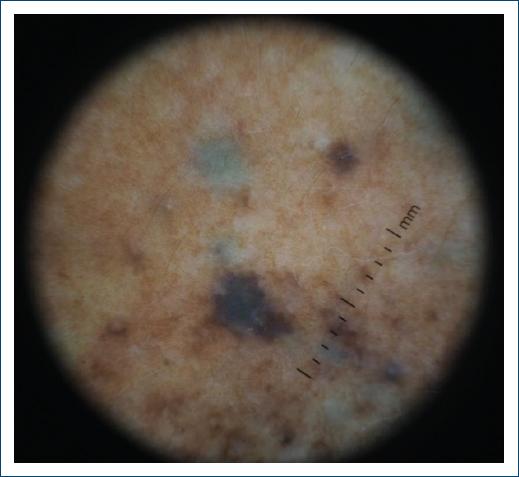 Extending agminated blue nevus in an immunosuppressed patient: a case ...