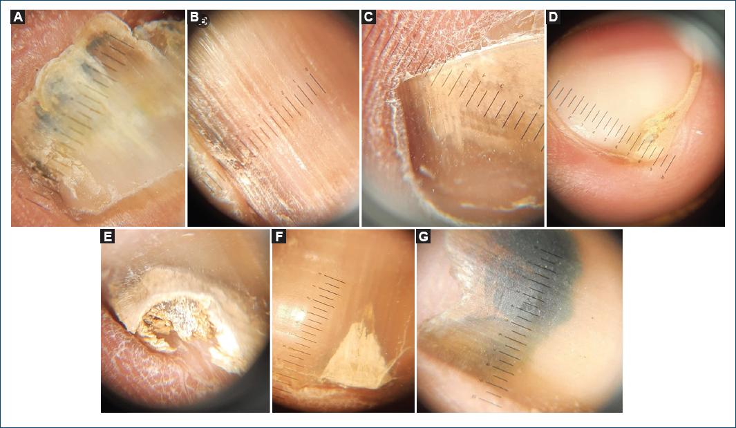 Association of onychoscopic features and clinicomycological profiles in ...