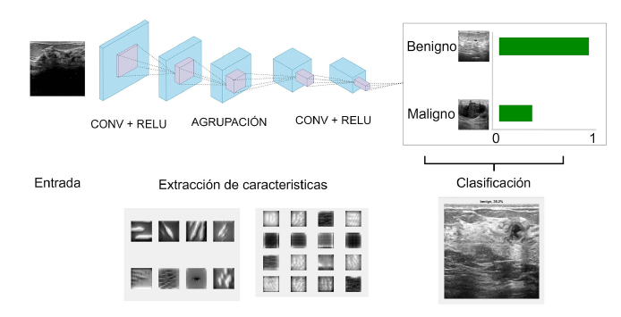 Detección temprana de cáncer de mama: clasificación de mastografías mediante un modelo de ...