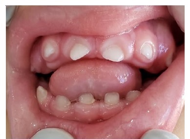 Eruption cyst in a patient with microcephaly: a case report