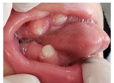 Eruption cyst in a patient with microcephaly: a case report