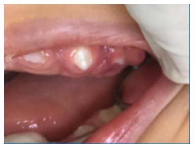 Eruption cyst in a patient with microcephaly: a case report