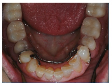 Removable partial denture metal framework manufactured by selective ...